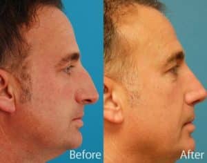 Surgical Solutions for a Hooked Nose | Becker Rhinoplasty Center