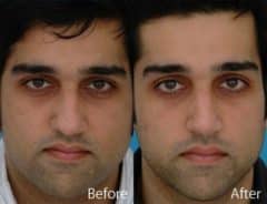 Surgical Solutions for a Hooked Nose | Becker Rhinoplasty Center
