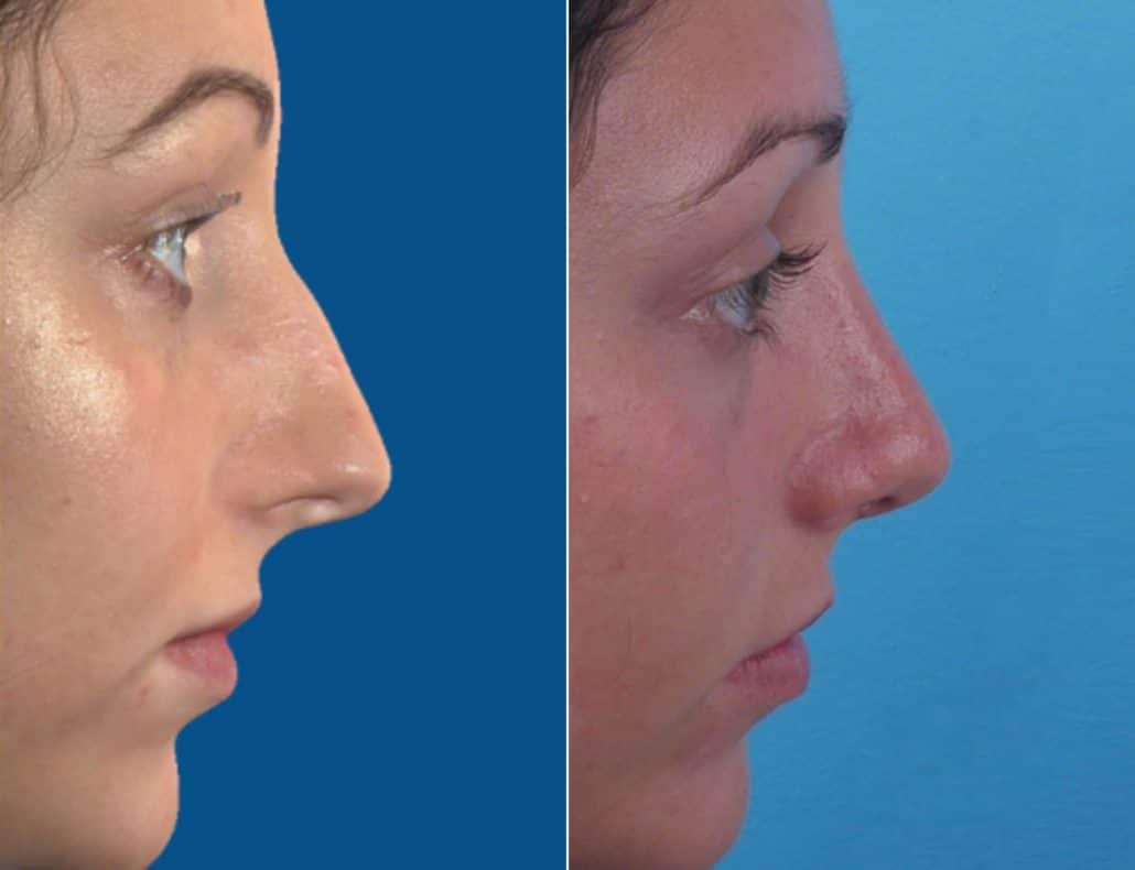 Nasal Bump Before And After Photos Becker Rhinoplasty Center