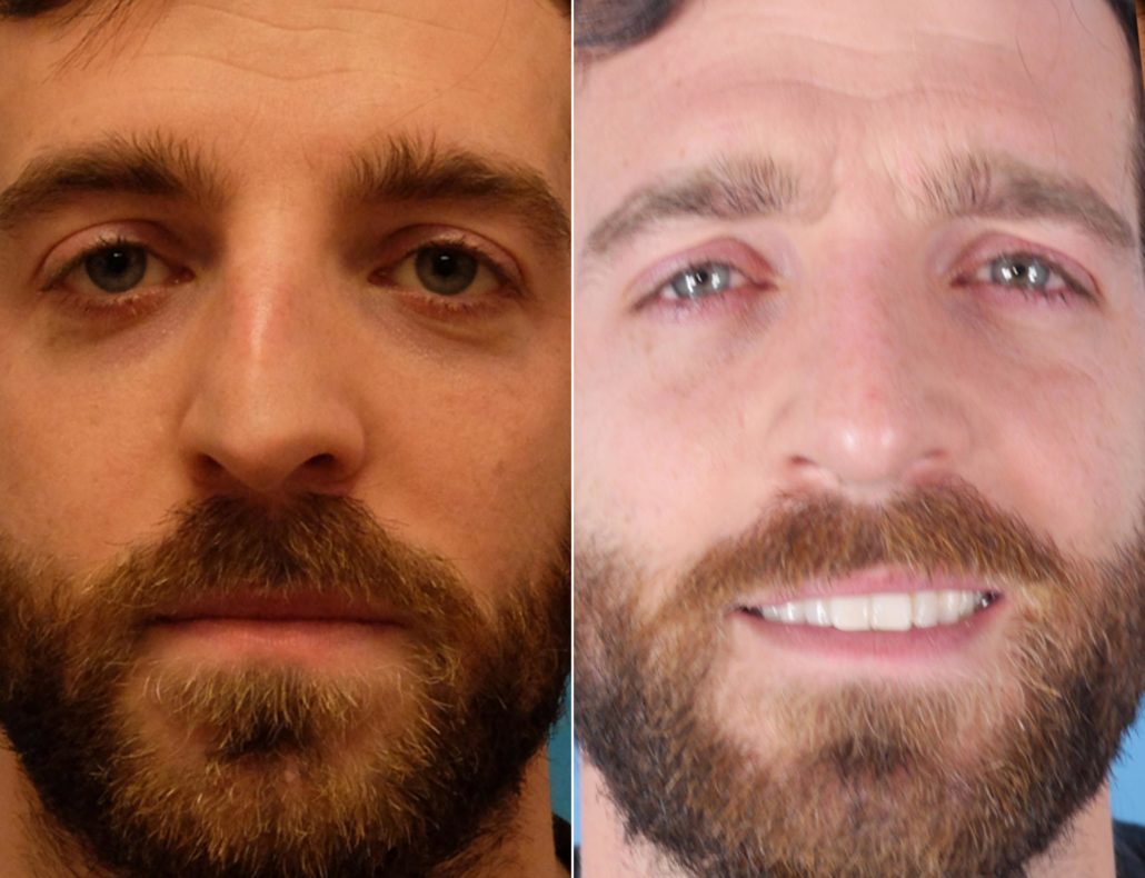 What is a Deviated Septum? | Becker Rhinoplasty Center