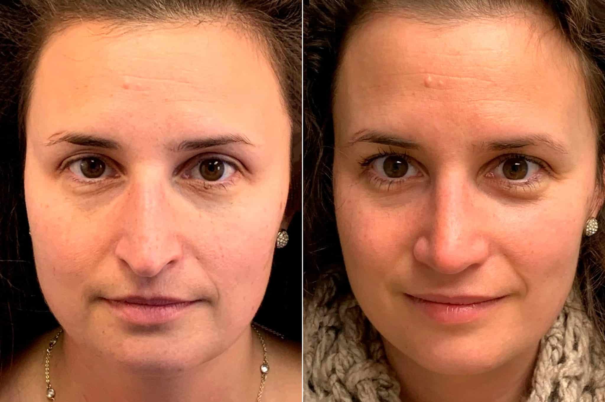 Septorhinoplasty Surgery: What It Is & When You May Need It