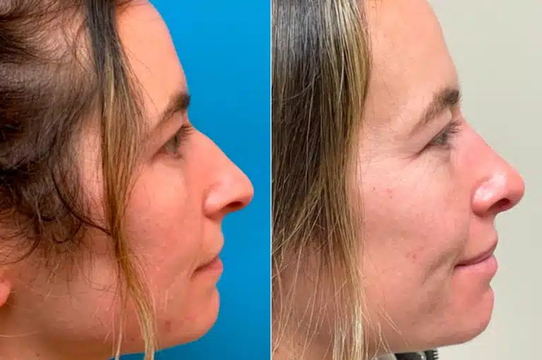 Rhinoplasty Recovery Timeline: From Day 1 to a Year