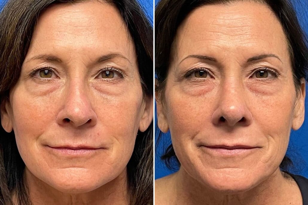 Transform Your Look: Nose Job Just the Tip | New Jersey