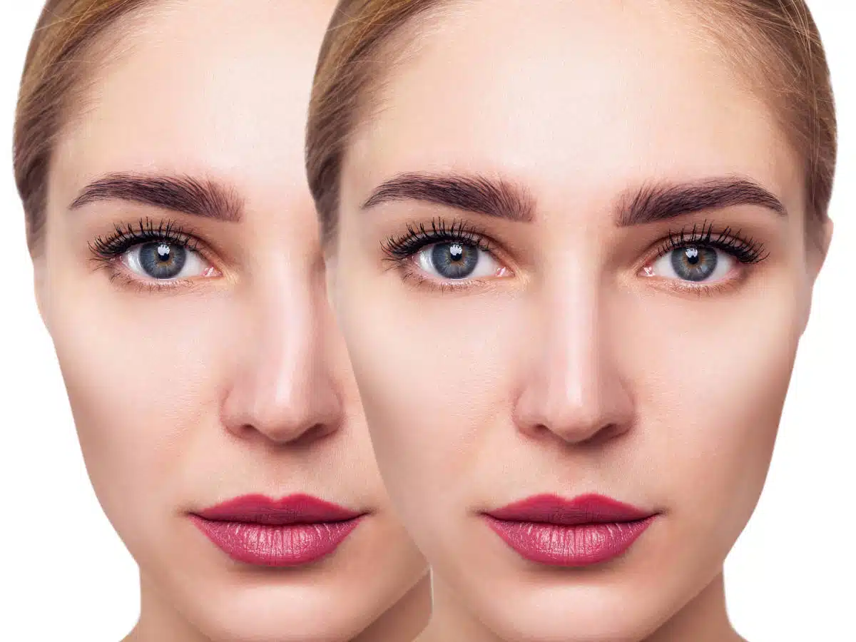 What is a Deviated Septum? | Becker Rhinoplasty Center