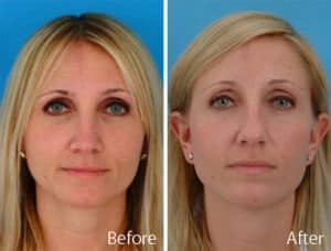 12 Types of Noses and Surgery Options For Each One