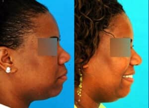 12 Types of Noses and Surgery Options For Each One