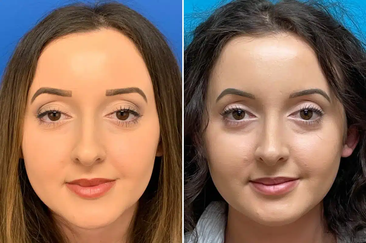 Transform Your Look: Nose Job Just the Tip | New Jersey