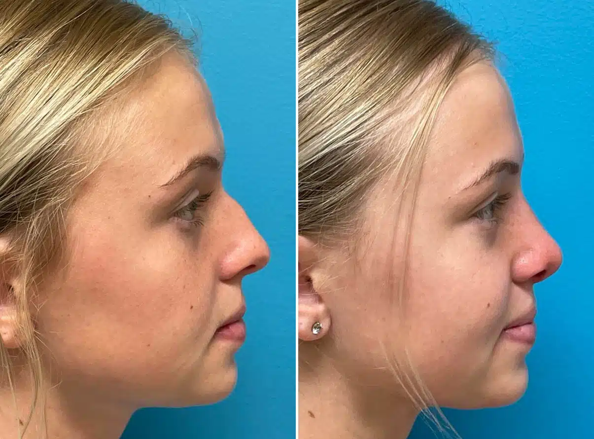 Does Liquid Rhinoplasty Last Forever? | Becker Rhinoplasty Center