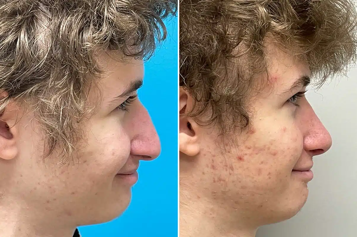 Understanding Post-Rhinoplasty Scar Tissue | Dr. Daniel Becker