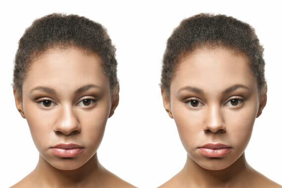 Ethnic Rhinoplasty for a Bulbous Nose in African Americans